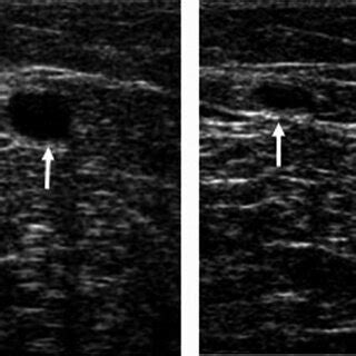 Ultrasound Assisted Foam Injection In The Small Saphenous Vein While Download Scientific