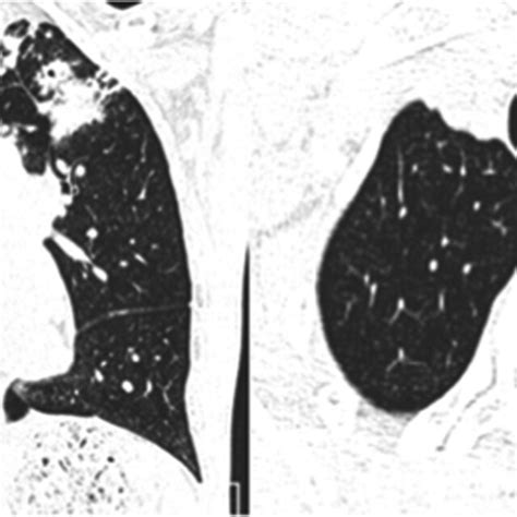 Frontal Chest X‐ray Showing Lobar Consolidation Of The Right Upper Lobe