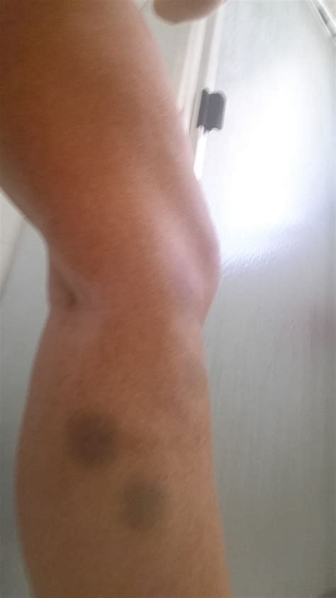 Leukemia Bruises Back Leukemia Symptoms You Shouldnt Ignore