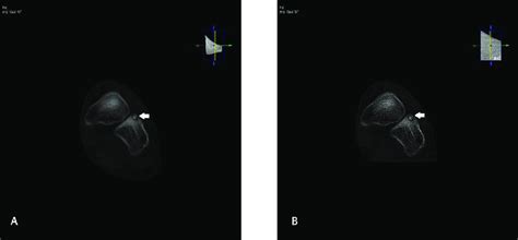 A 17 Year Old Male Presented With Right Cuboid Osteoid Osteoma Axial