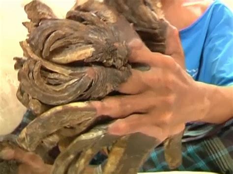 Bangladesh Man With Tree Man Illness Gets First Surgery Wptv Com