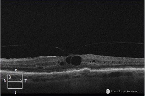 Cystoid Macular Edema CME September 2022 Illinois Retina