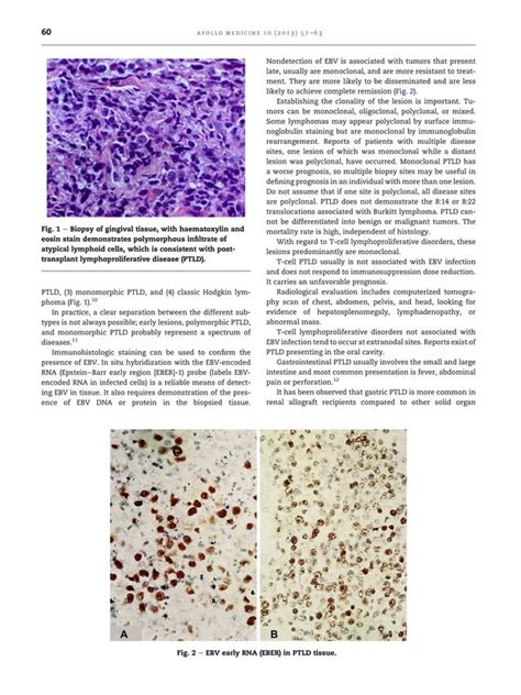 Post Transplant Lymphoproliferative Disease Pdf