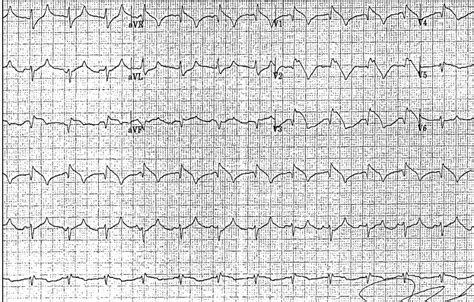 Stemi Mimics Resus