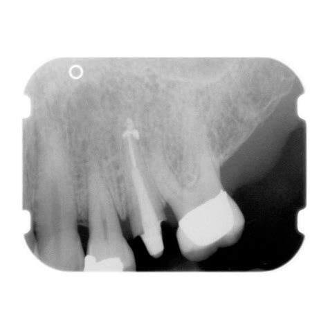 Corecem dual-cure dental resin cement & core build-up - RTD Dental