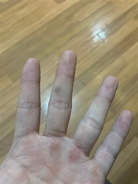 손가락 피 고임and피 응고 지식in