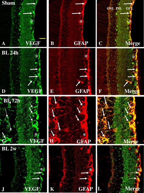 Expression And Distribution Of Vegf Green And Gfap Red In The