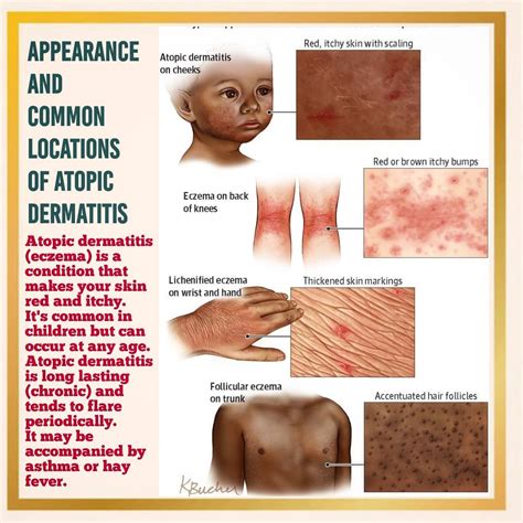 Papular Eczema Symptoms Causes And Treatments 54 Off