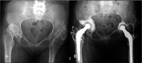 The Outcome Of 241 Charnley Total Hip Arthroplasties Performed By One