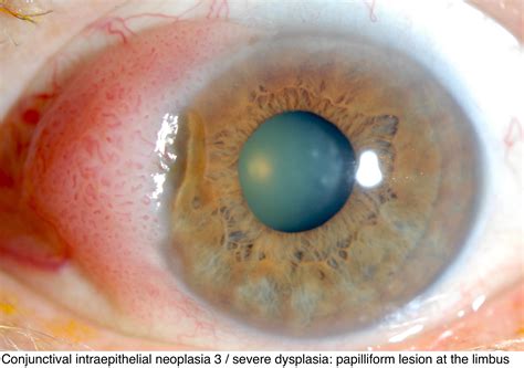 Pathology Outlines Conjunctival Intraepithelial Neoplasia