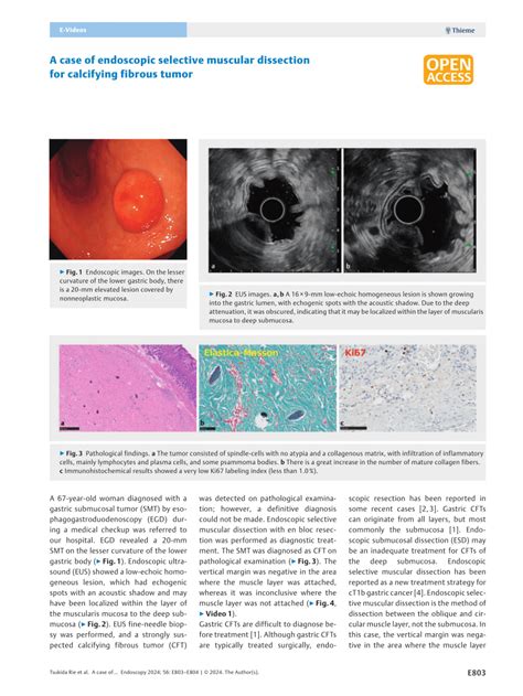 Pdf A Case Of Endoscopic Selective Muscular Dissection For Calcifying Fibrous Tumor