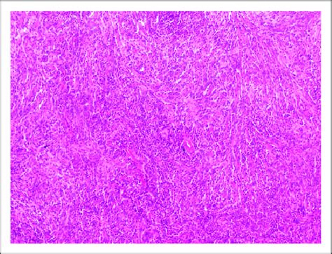 The Tumor Is Composed Of Plump Spindle Cells Arranged In Fascicular