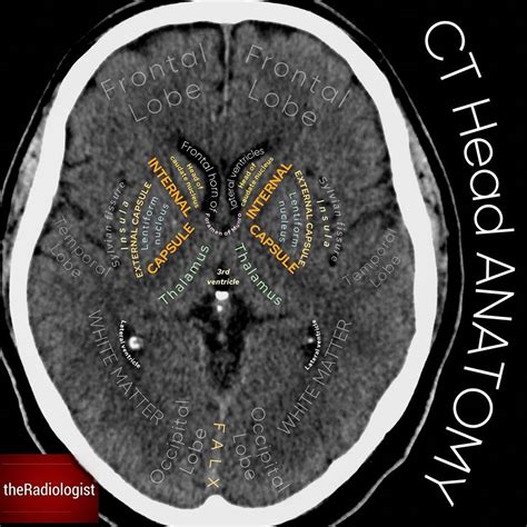 รวมกัน 95 ภาพ Ct Brain Contrast Vs Non Contrast คือ ใหม่ที่สุด