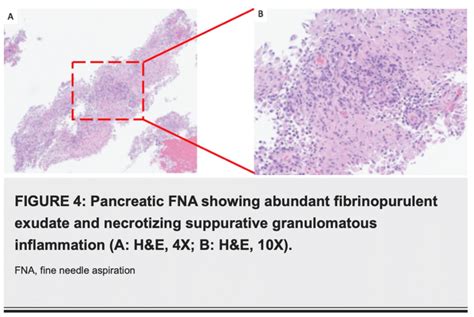Pancreatic Fna Showing Abundant Fibrinopurulent Exudate And Necrotizing