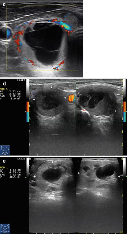 Percutaneous Ethanol Injection Pei For Thyroid Cysts And Other Neck