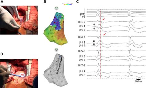 A Epicardial Mapping During Open Chest Surgery B The Upper Figure