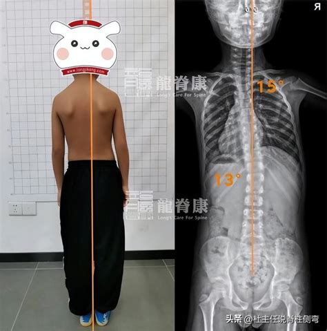 孩子含胸駝背、不良體態，如何通過訓練矯正？ 每日頭條