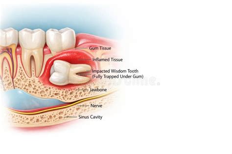 Diagram Showing Dental Anatomy Of An Impacted Wisdom Tooth Along With