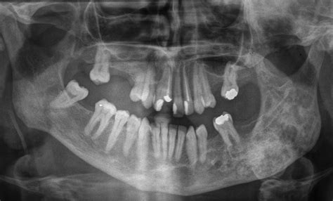 Fibrous Dysplasia Jaw