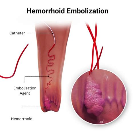 Hemorrhoid Embolization Brooklyn Bronx Hemorrhoid Embolization