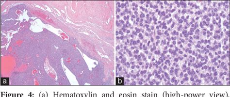 Figure 1 From Intracranial Ewing Sarcoma A Case Report Semantic Scholar