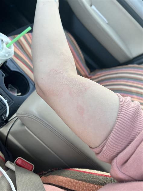 Ringworm Is Growing I 20f Have Had It On And Off For 8 Years And The
