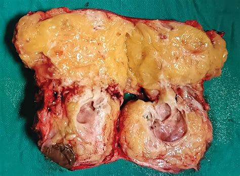 Rotten Bloody Bowels Of Eternal Disease Lipoma
