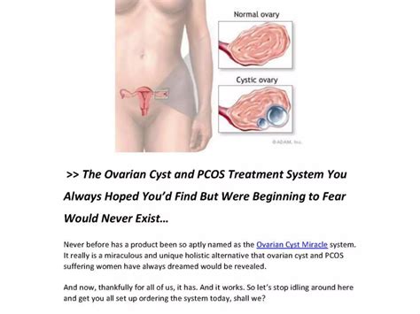 Ovarian Cyst Miracle Scam Ppt