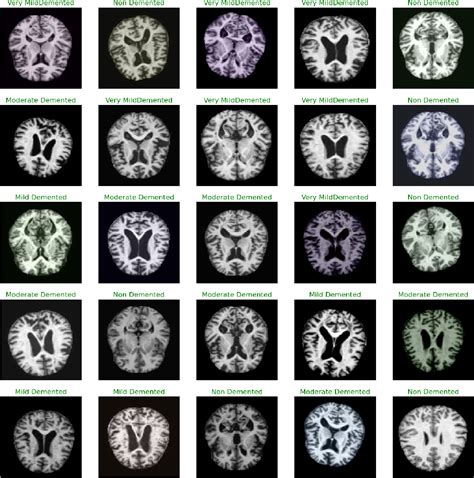 Leveraging Deep Learning And Xception Architecture For High Accuracy MRI Classification In