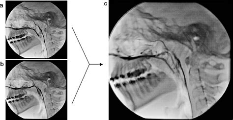 Figure 1 From The Furlow Palatoplasty For Velopharyngeal Dysfunction