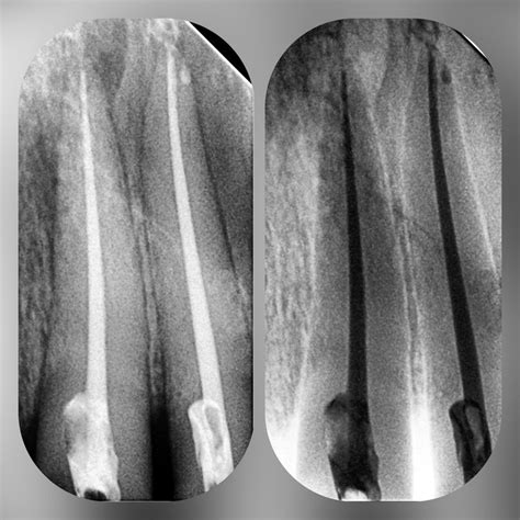 Dr Mahmoud Nader On Linkedin Daily Routine Treatment Of Upper Teeth