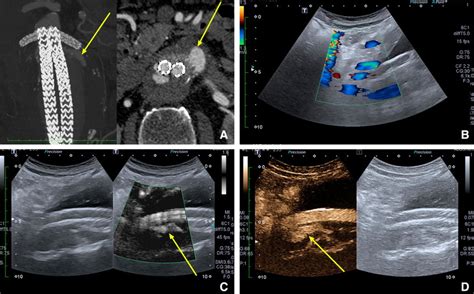 A Type I Endoleak Yellow Arrow According To Four Different Imaging Download Scientific