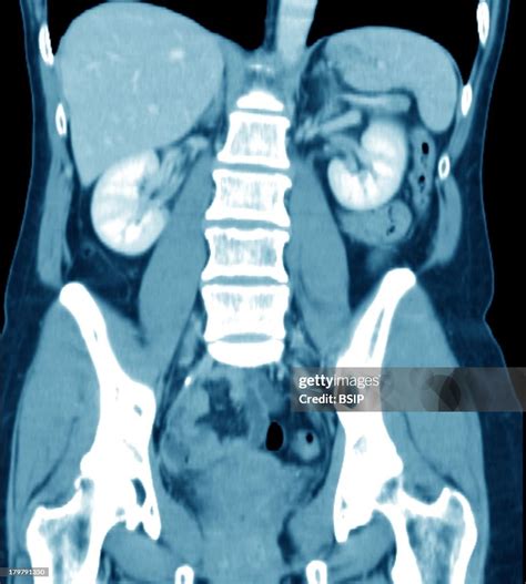 Ct Scan Of The Abdomen Frontal View News Photo Getty Images