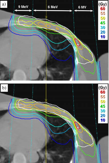 Electron Beam Dose Distributions For One Of The Patients With 6 And 9 Download Scientific