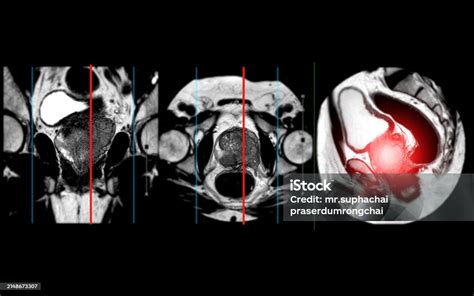 Mri Of The Prostate Gland Reveals A Focal Abnormal Signal Intensity
