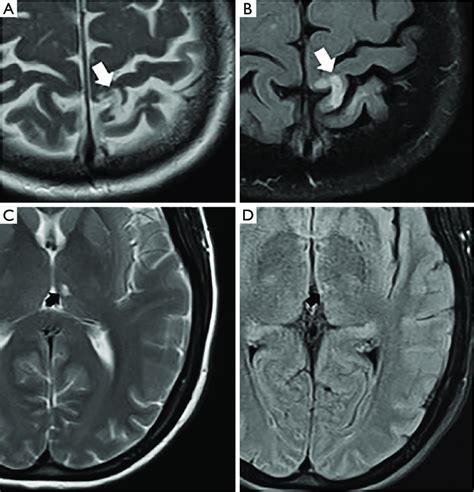 Silent Brain Infarctions A B A 78 Year Old Asymptomatic Male With Download Scientific
