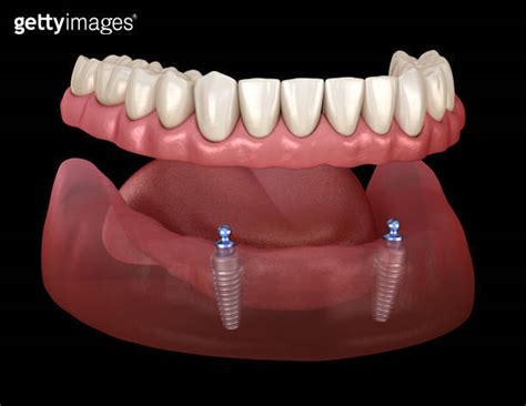 Mandibular Removable Prosthesis All On 2 System Supported By Implants