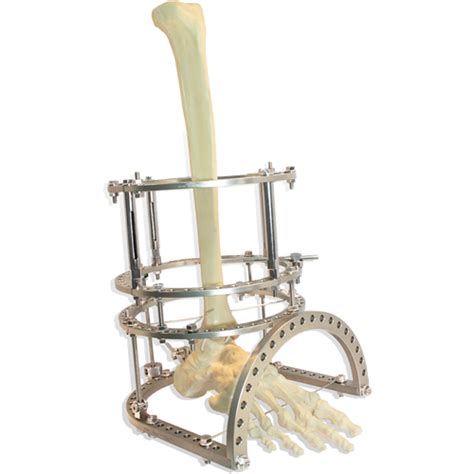 Circular External Fixator Aerospace Aluminium Selaz