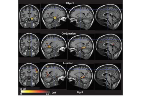 Statistical Maps Indicating P Value Of Correlation Between Cortical Download Scientific Diagram