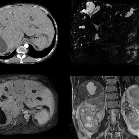 Ultrasound Showing Heterogenous Parenchymal Texture With An Ill Defined
