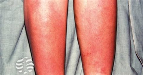Pretibial Myxoedema In Graves Disease Image