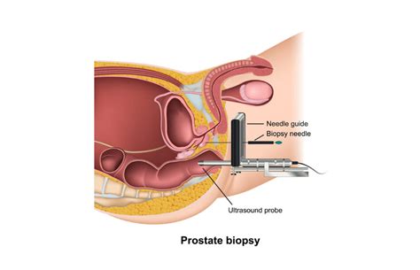 Transperineal Prostate Biopsy With Mri Us Guidance