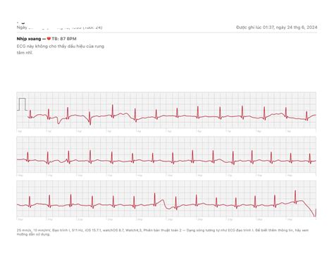 Hi My Doctor Said Svt But Some Say Sinus Tach On Ecg Raskcardiology