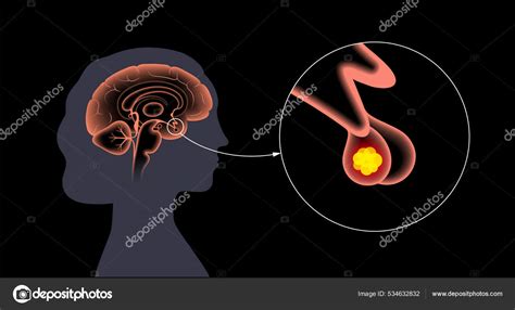 Pituitary Adenoma Cancer Stock Illustration By ©pikovit 534632832