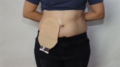 British Journal Of Community Nursing Patient Centred Stoma Care
