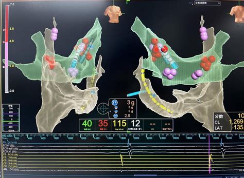 顽固性晕厥患者的福音！随州市中心医院成功开展全市首例心脏迷走神经节消融术 随州市中心医院