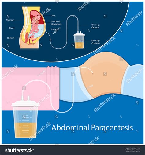 Ascites Paracentesis Medical Procedure Diagnostic Abdominal Stock
