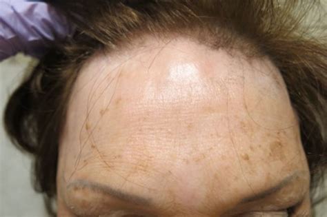 Alopecias In Lupus Erythematosus Lupus Science And Medicine