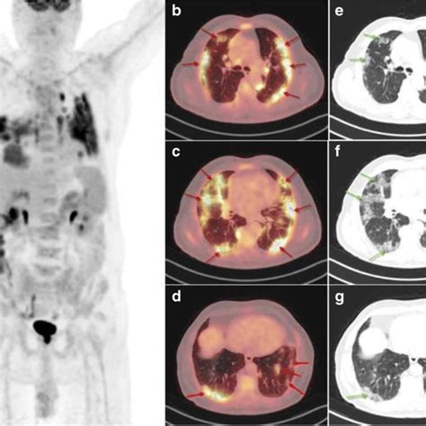 Incidental Detection Of COVID 19 In An 82 Year Old Patient With A