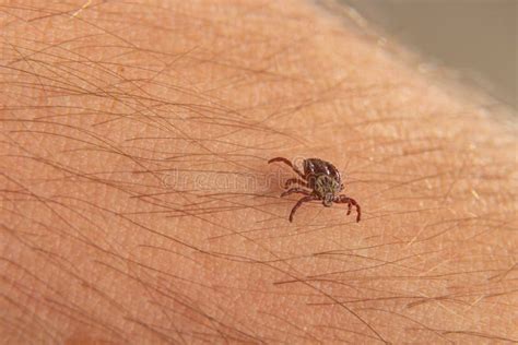 Close Up Deer Tick Trying To Bite Through Human Skin Danger Infection